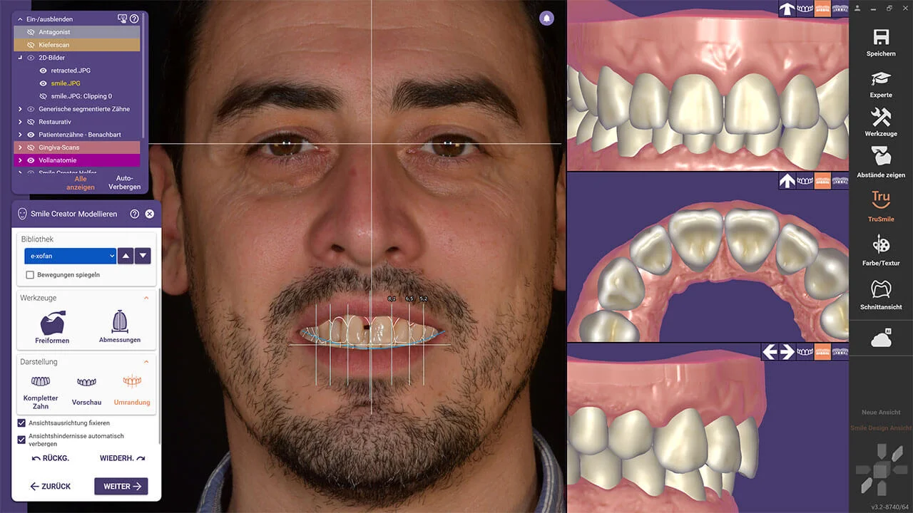 exocad 3.3 Chemnitz - Try Before You Buy | Dental Digital Design